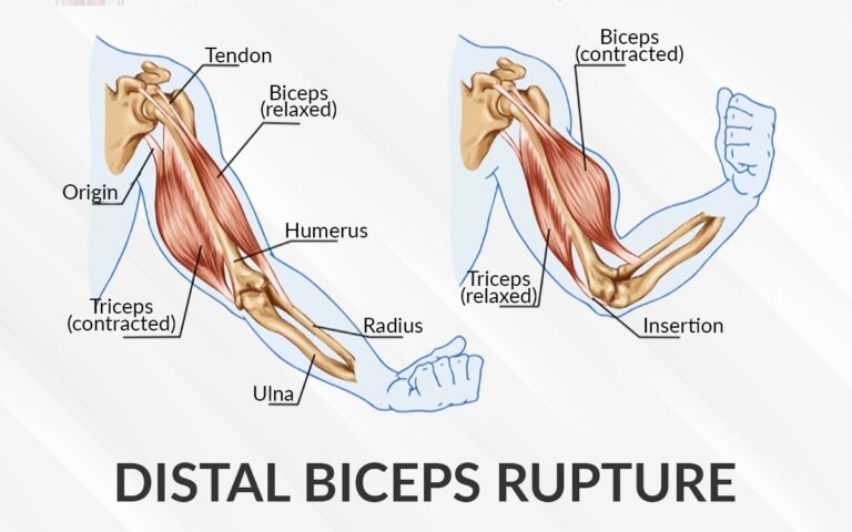 Biceps tendon injury – Renison Knee & Shoulder Clinic